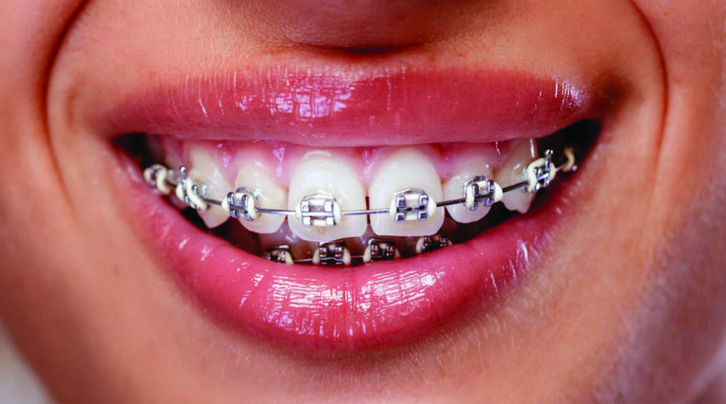 Fixed Braces - CXC Dental